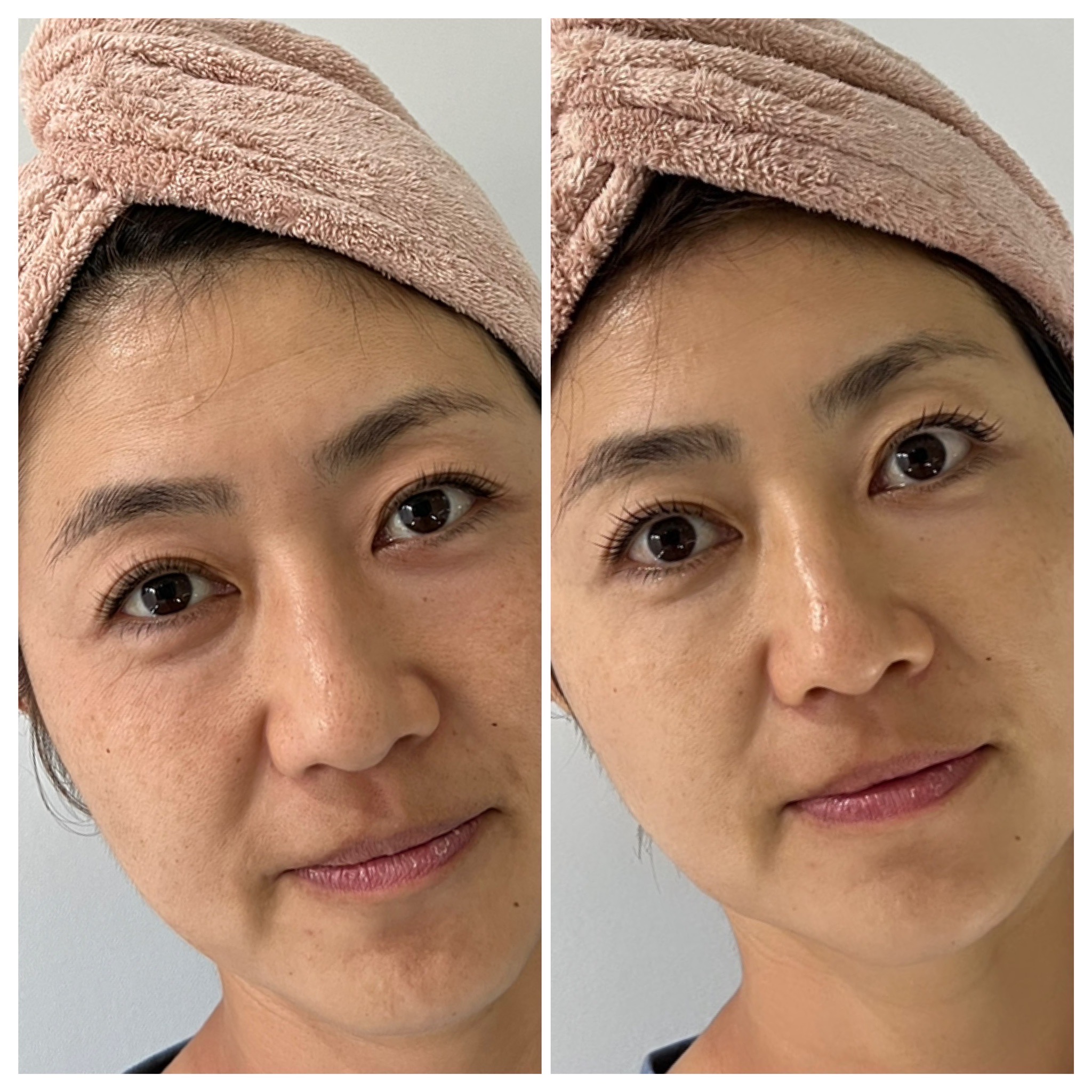 【ansR（アンス）Japanese HIFU Salon】バンコクの痛みレスHIFU専門店でリフトアップ@トンロー｜BANGKOK ...